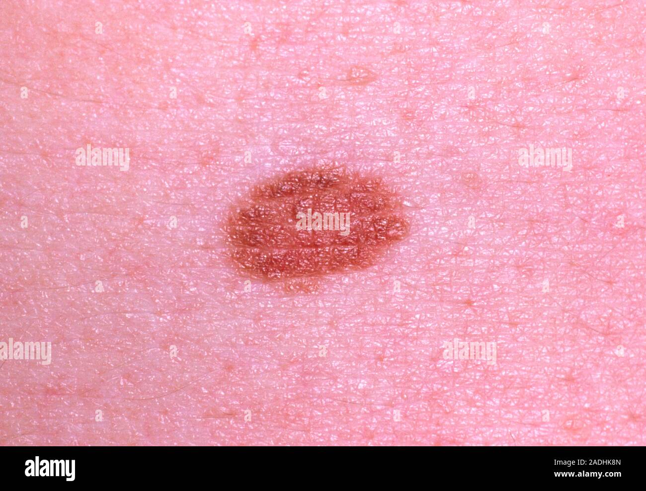 Mole. Close-up of a benign melanocytic naevus, or mole, on human skin ...