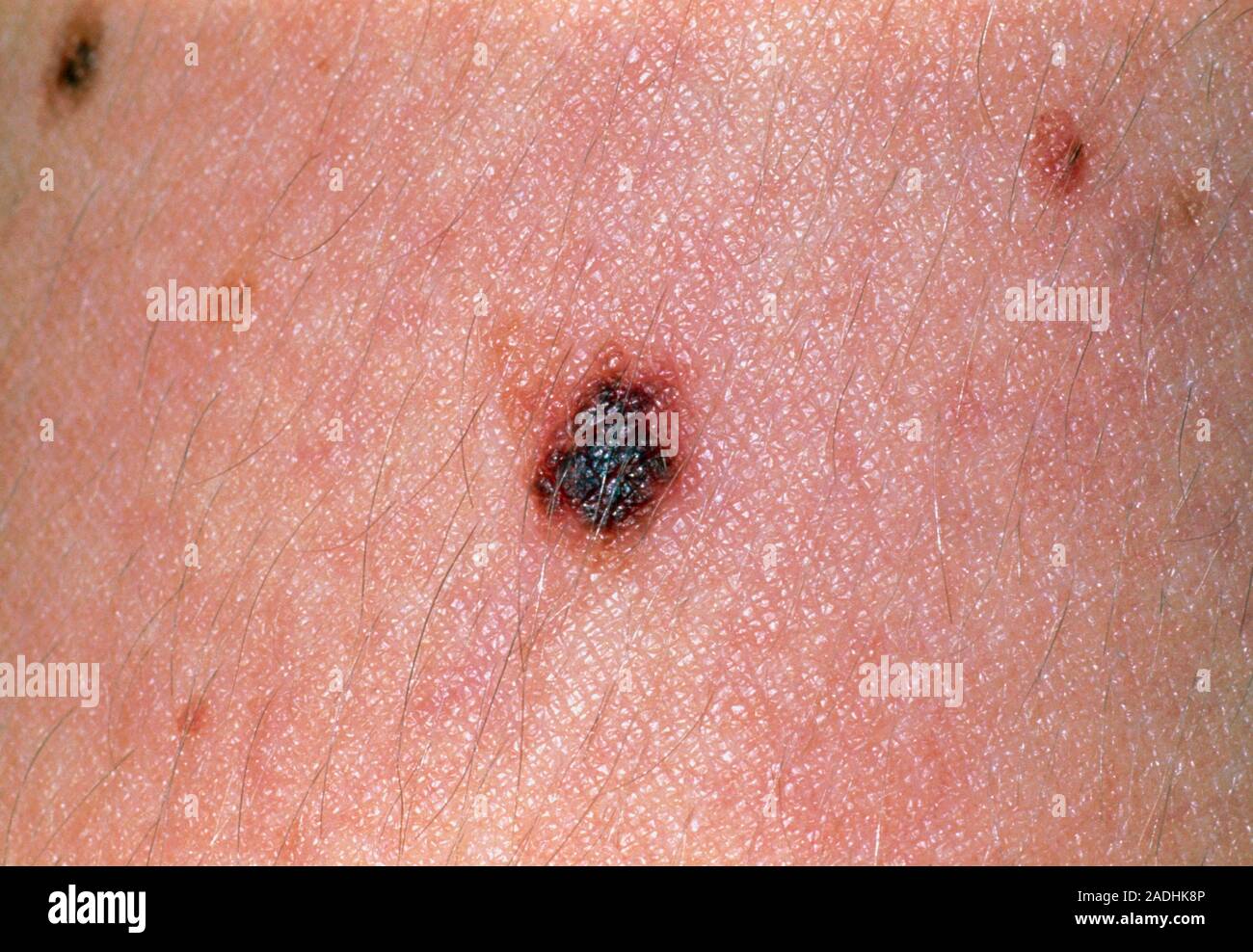 Benign mole. Compound melanocytic (pigmented) naevus, also known as a ...