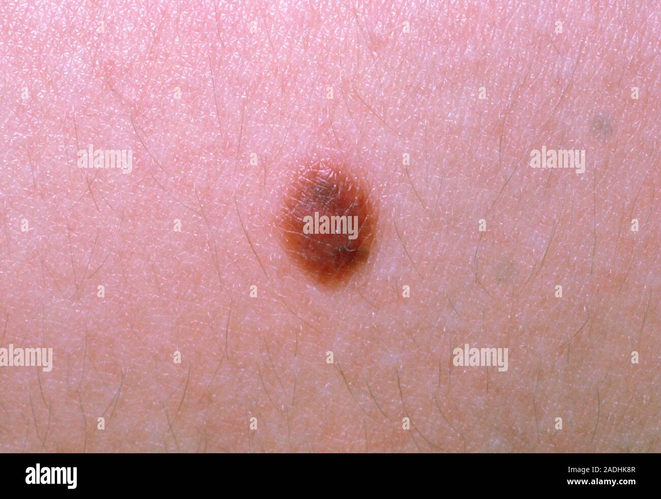 Desmoplastic spitz naevus. Close-up of a dark brown desmoplastic spitz ...