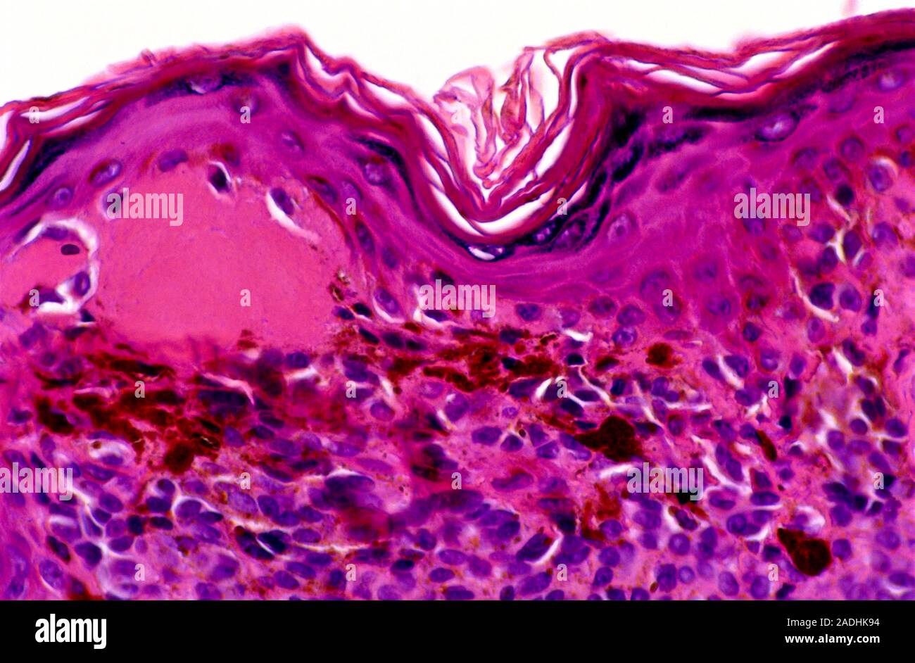 Compound naevus. Light micrograph of a section through a compound ...