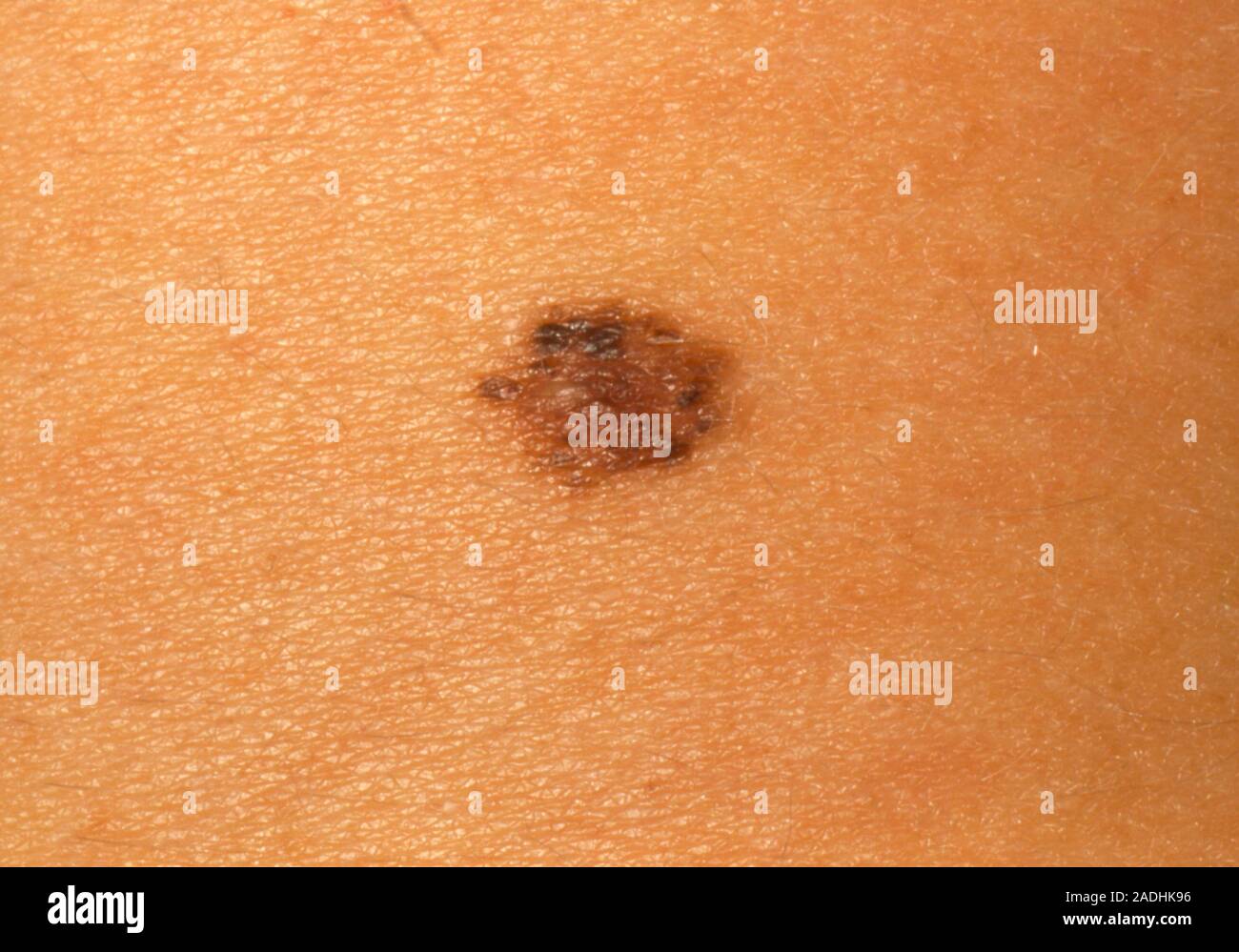 Compound naevus. Close-up of a compound naevus, or mole, on the skin of ...