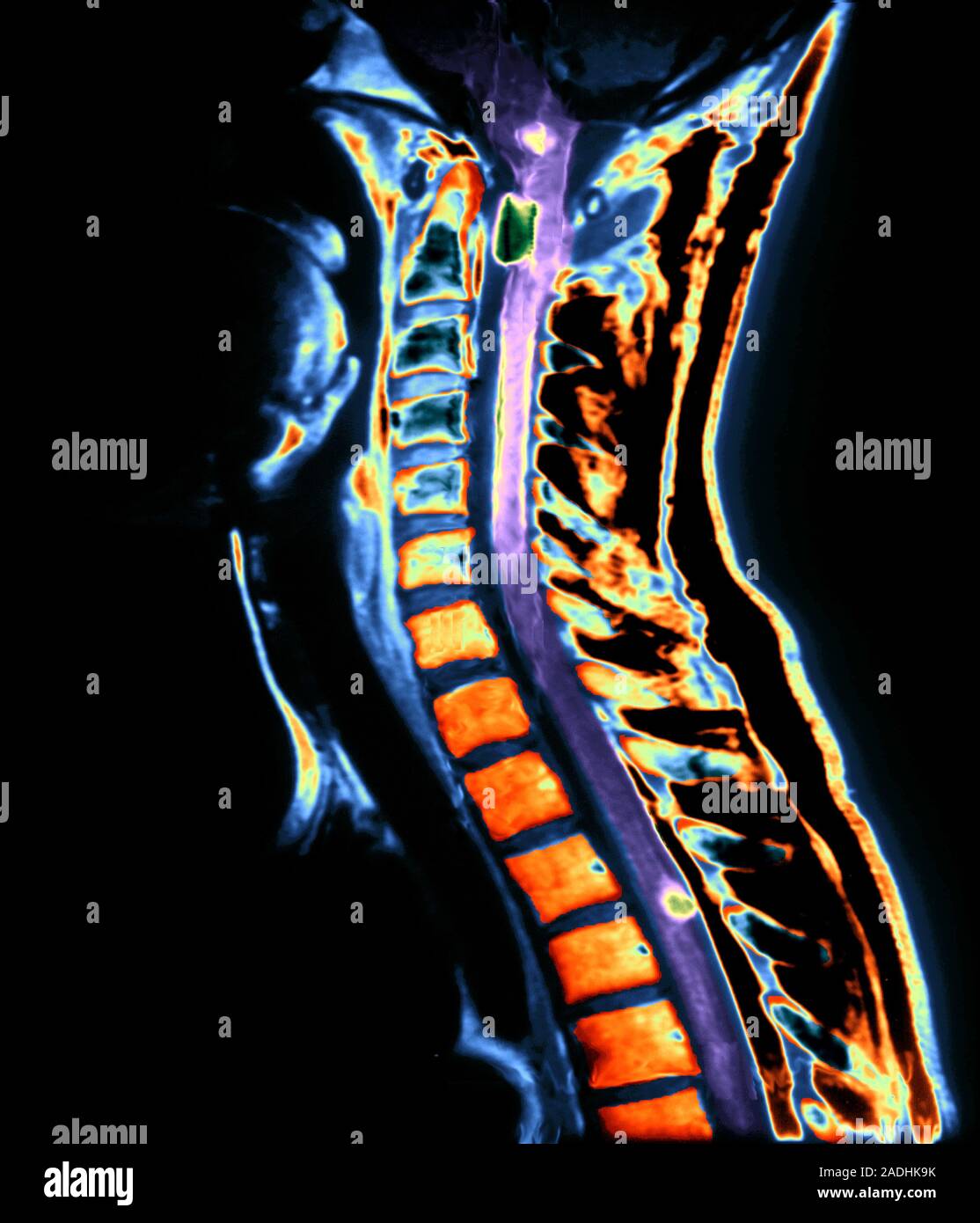 Spinal neurofibromas. Coloured sagittal (side) MRI (magnetic resonance ...