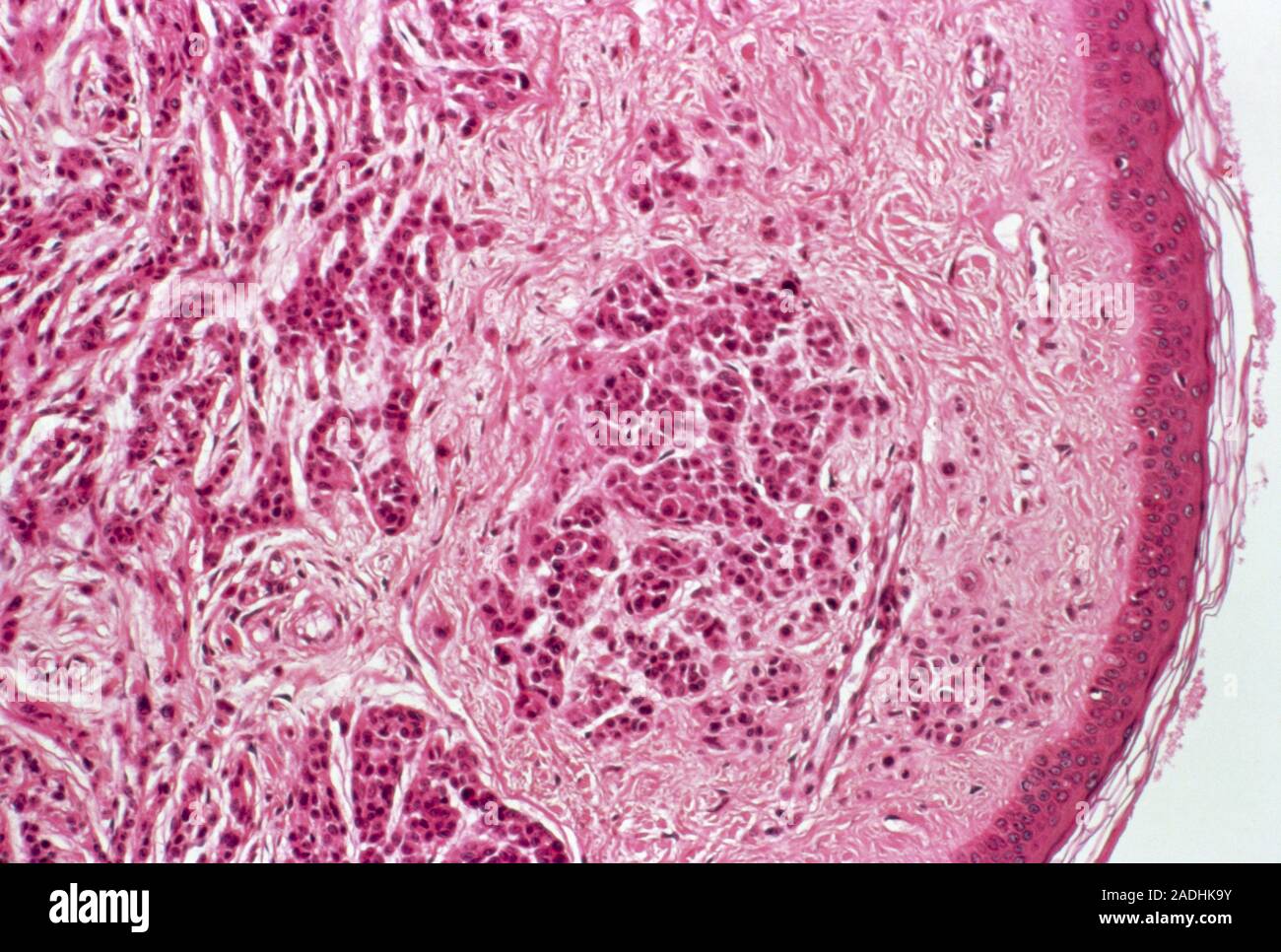 Skin mole. Light micrograph of a section through a compound naevus, a ...