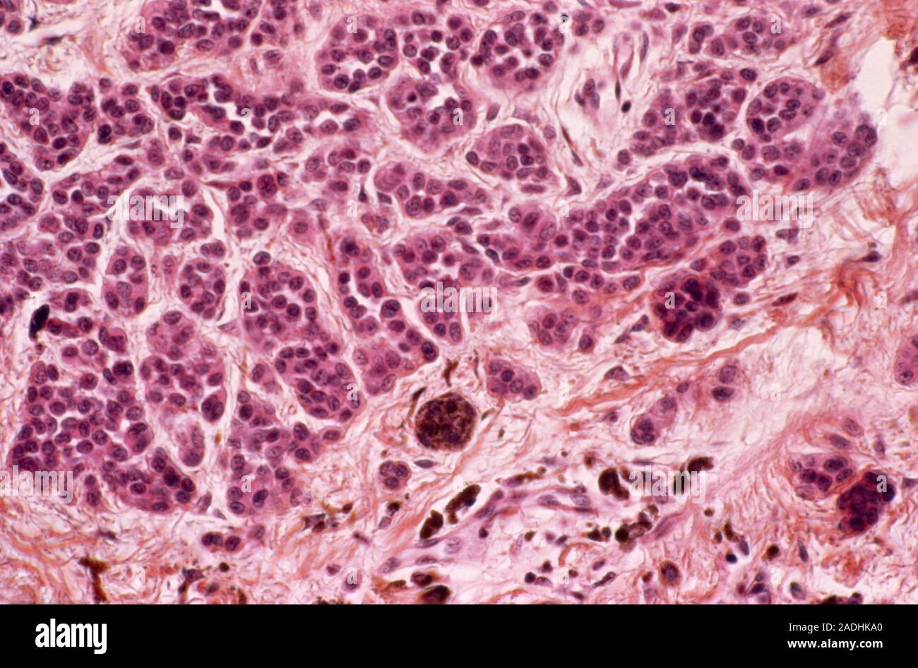 Skin mole. Light micrograph of a section through a compound naevus, a ...