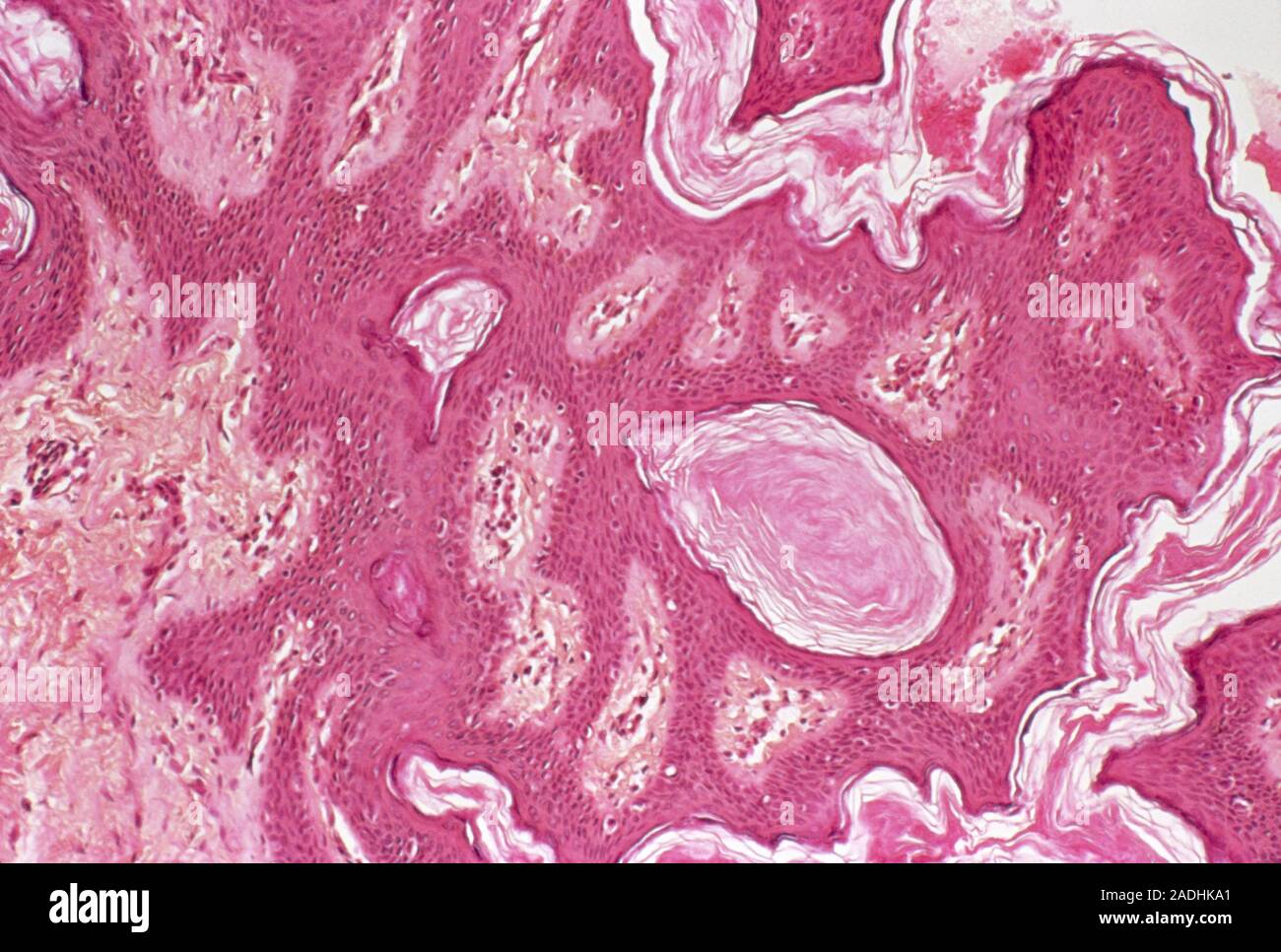 Warty skin mole. Light micrograph of a section through a warty naevus ...