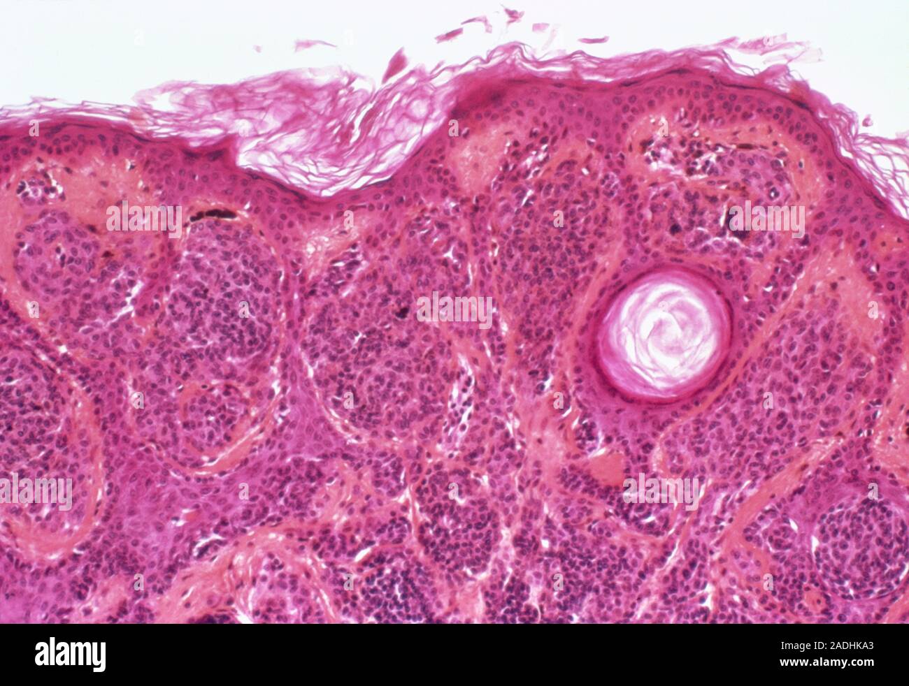 Skin mole. Light micrograph of a section through a junctional or ...