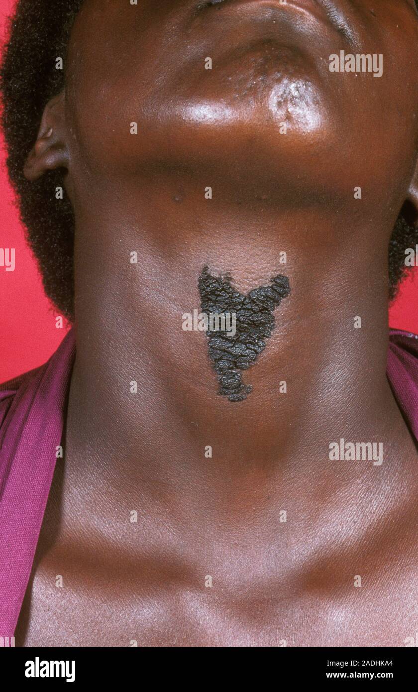 Mole. Verrucous naevus or mole on the neck of a patient. Verrucous ...