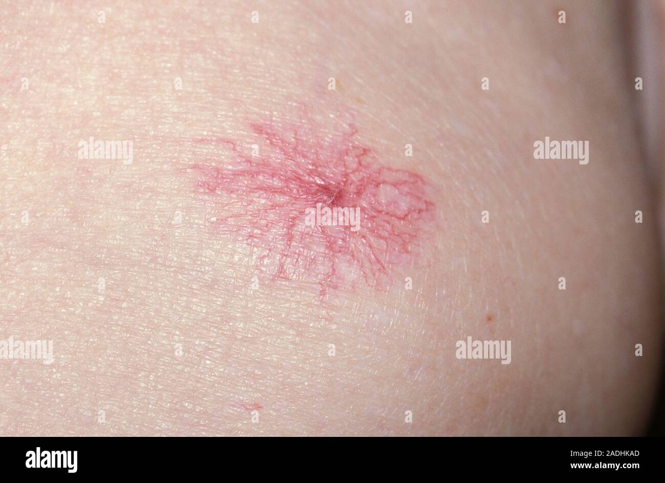 Spider naevus (telangiectatic angioma) on a patient's skin. This mark ...