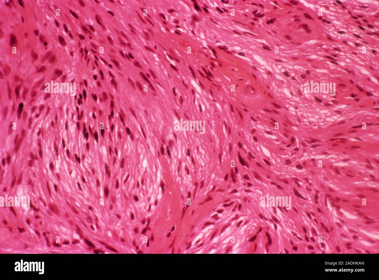 Neurinoma tumour. Light micrograph of a section through a neurinoma ...