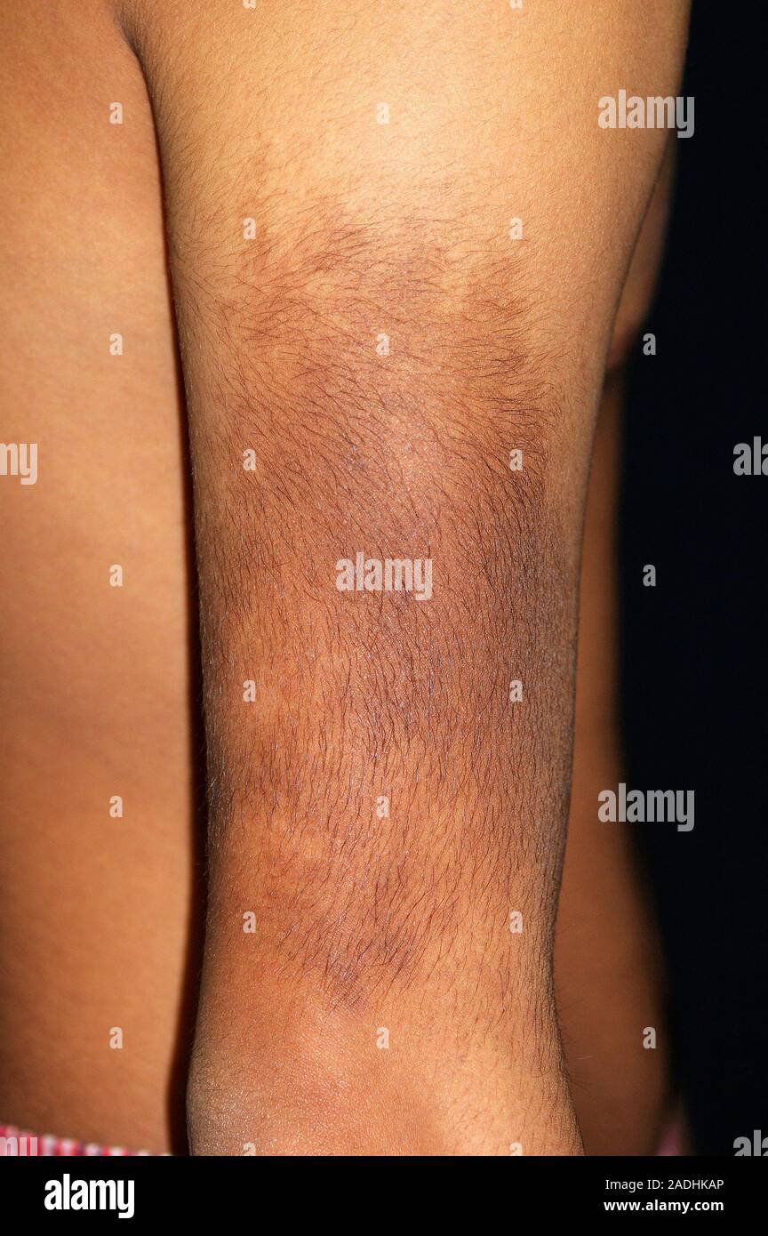 Large birthmark, or pigmented naevus, on the arm of a 15-year-old boy ...