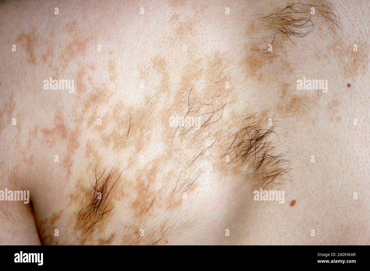 Becker's naevus on the back of an 18 year old male. This benign ...