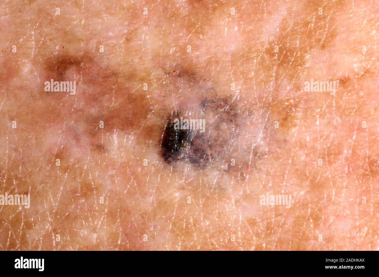 Mole on a 70 year old man's skin. This type of mole is known as a ...