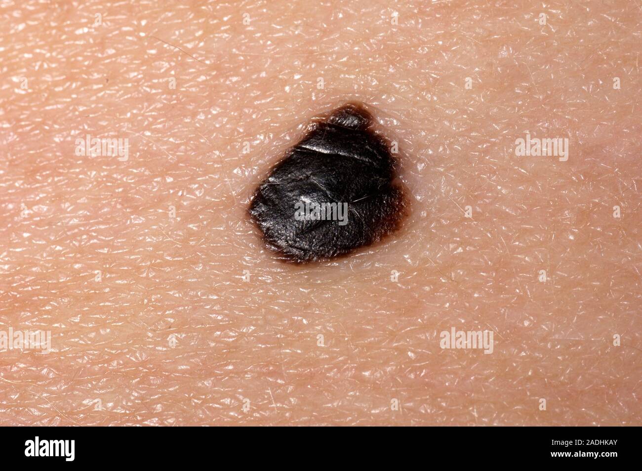 Mole on the skin of a 17 year old girl. This type of mole is known as a ...