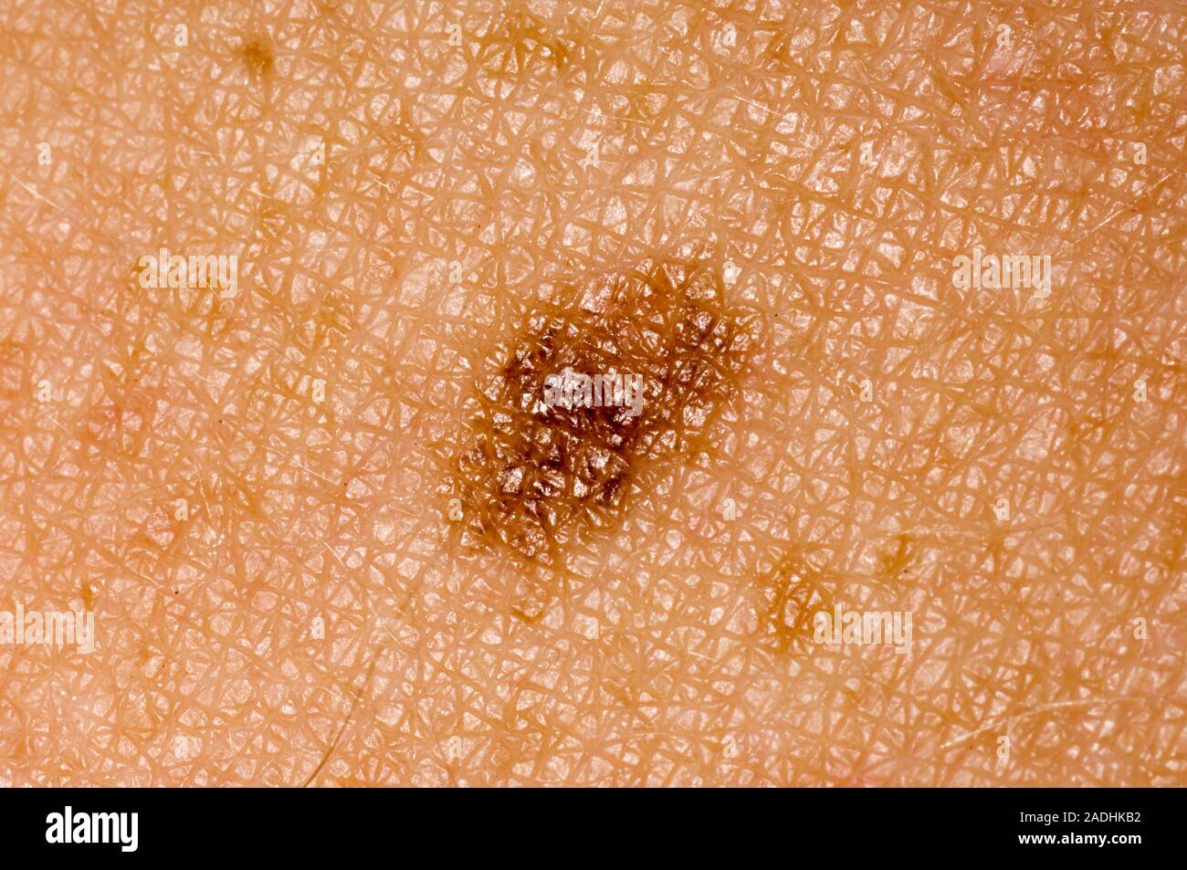 MODEL RELEASED. Mole on the skin of a 41 year old man. This is a benign ...