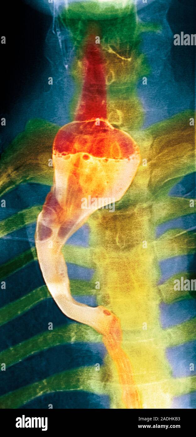 Neurofibromatosis and dysphagia. Coloured X-ray of a 24 year old man ...