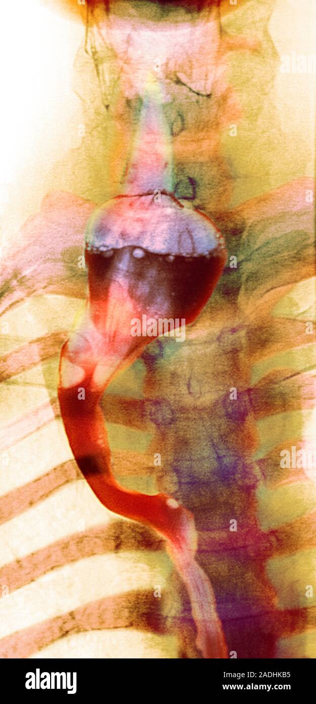 Neurofibromatosis and dysphagia. Coloured X-ray of a 24 year old man ...
