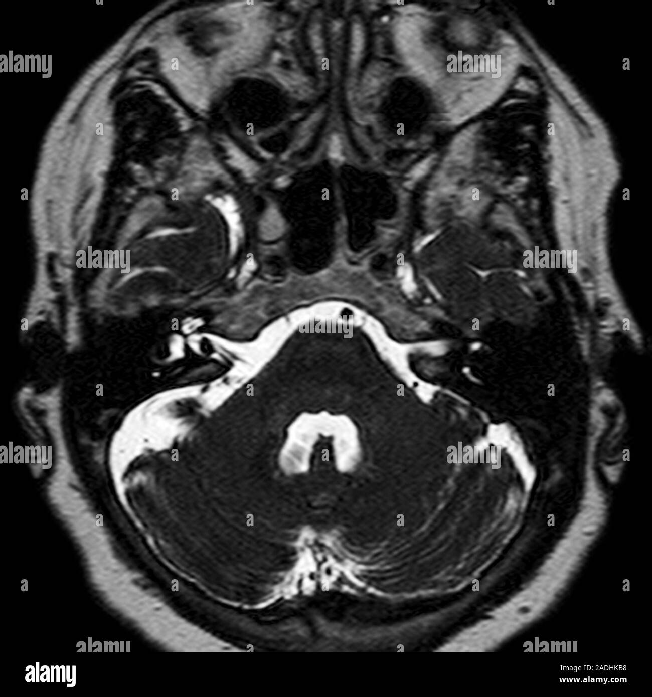 What Does A Neuroma Look Like On An Mri