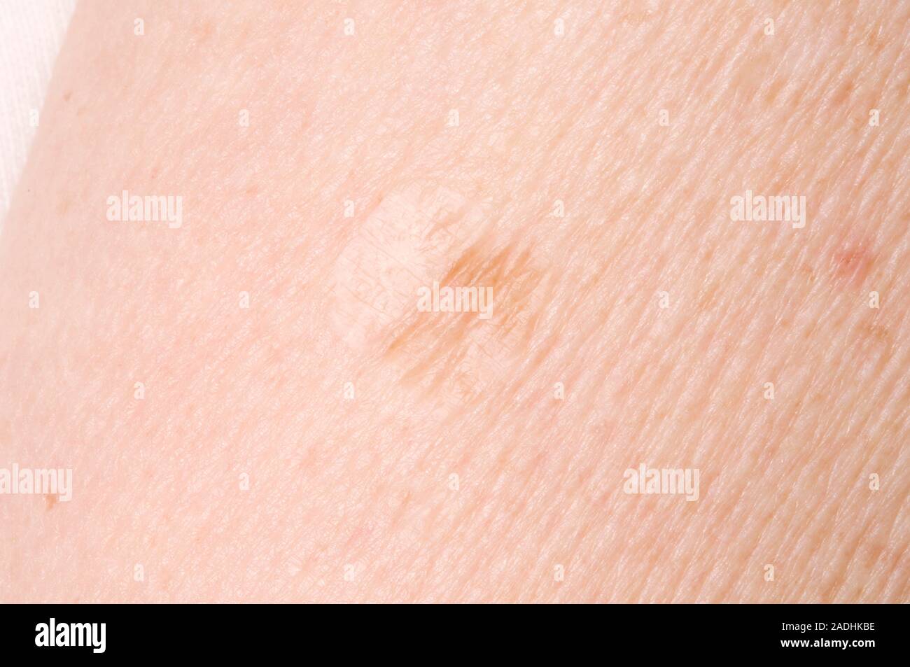 Mole (melanocytic naevus) on a 62 year old woman's skin. Moles are ...