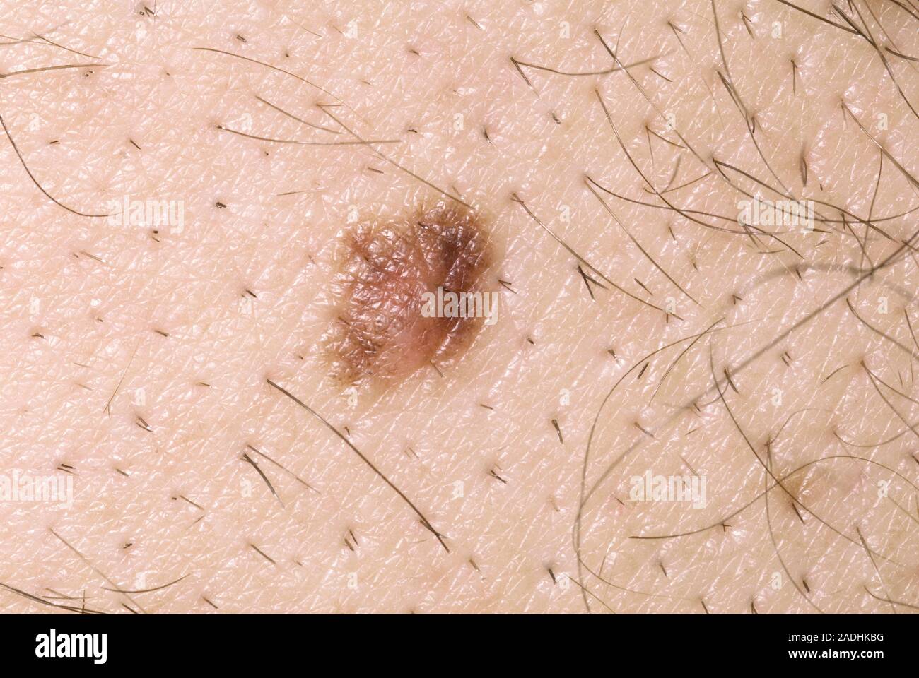 Intradermal naevus (brown) on a 50 year old man's skin. An intradermal ...