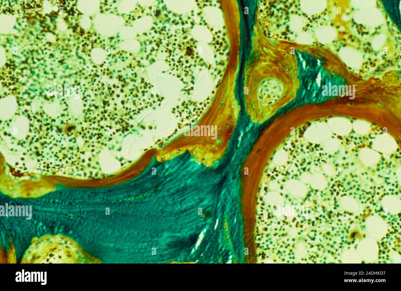 Osteomalacia Histology Bone: Histology, Constituents And Types
