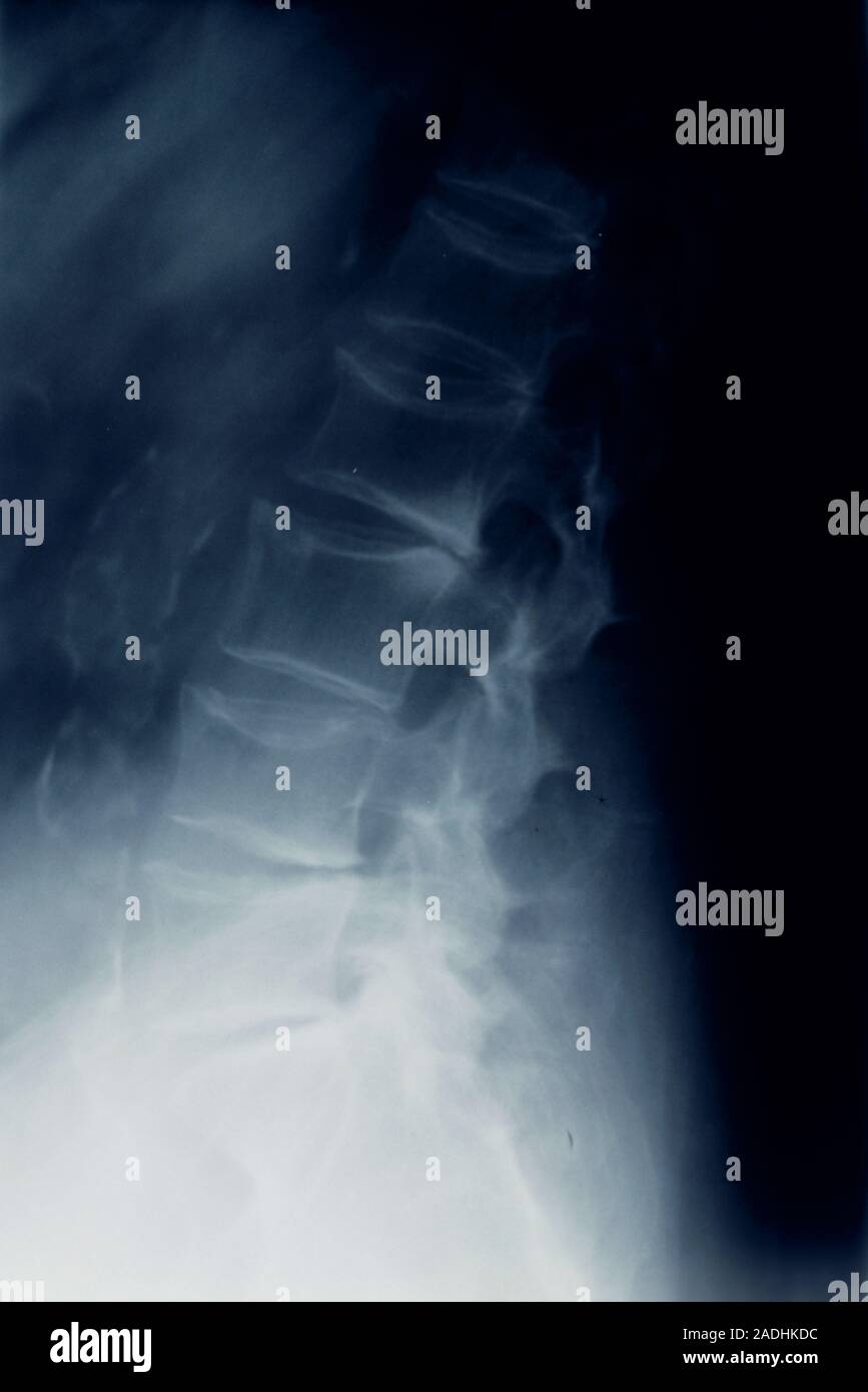 X-ray (blue tint) of the lumbar spine of a woman suffering from ...