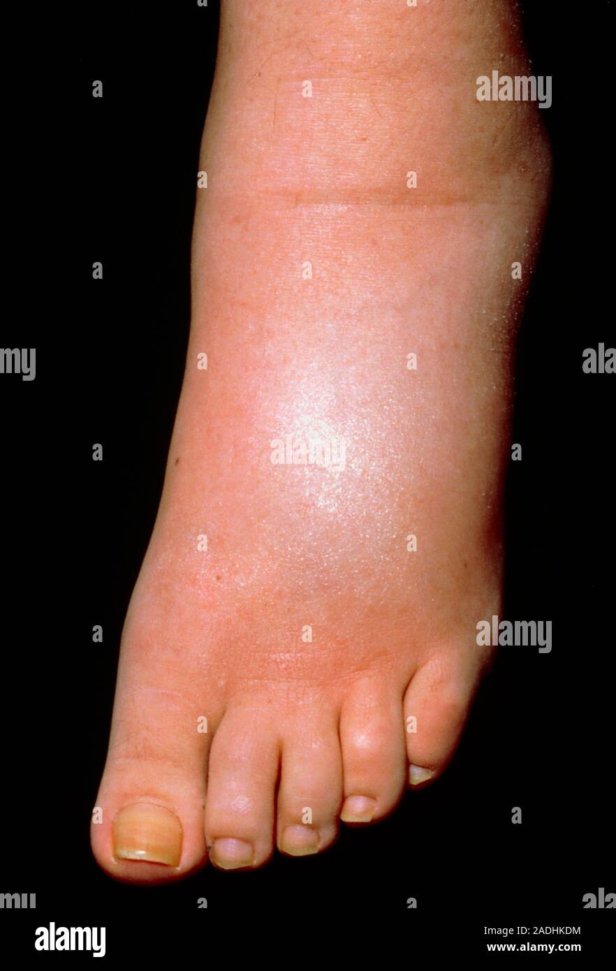 A Swollen Foot In A Case Of Pitting Oedema Oedema Also Called Dropsy