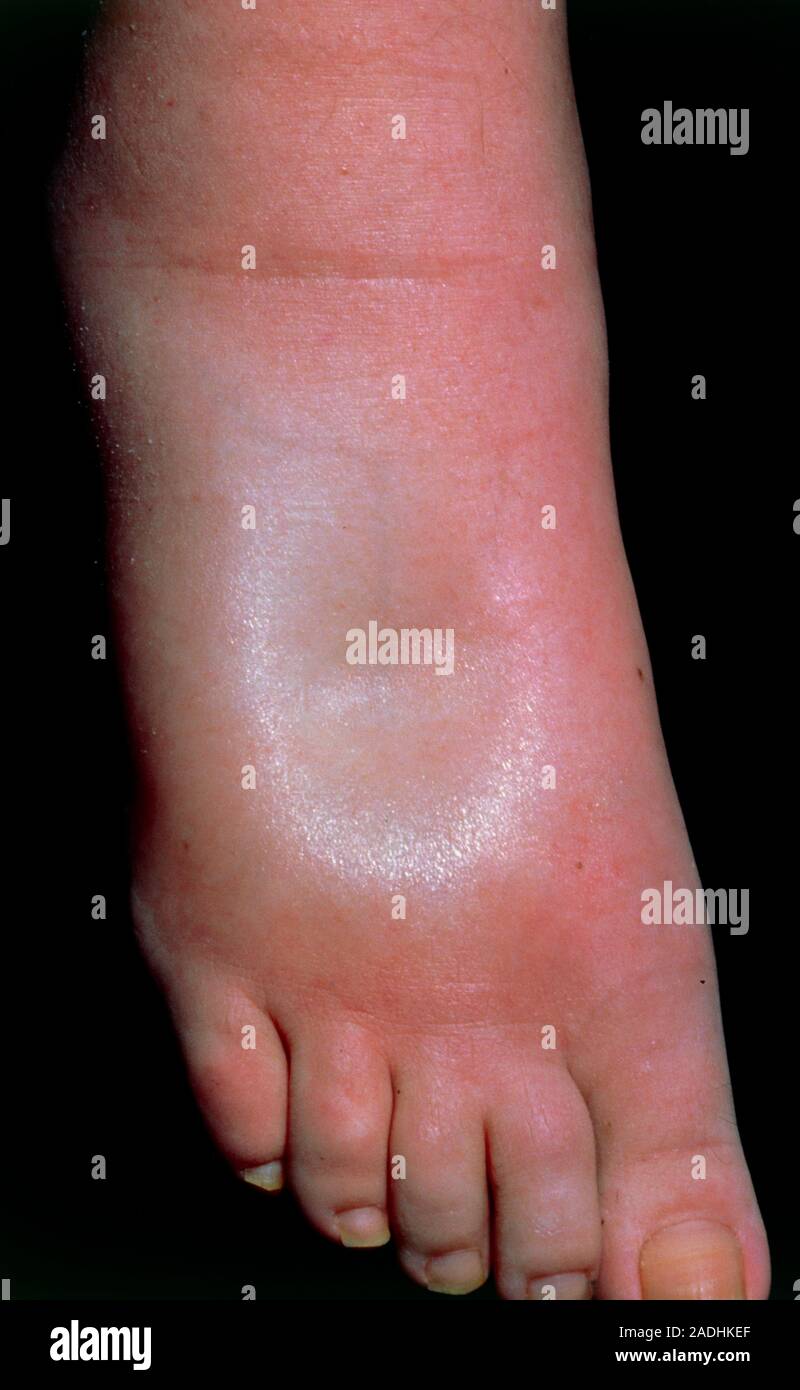 A swollen foot in a case of pitting oedema, showing an indent in the ...