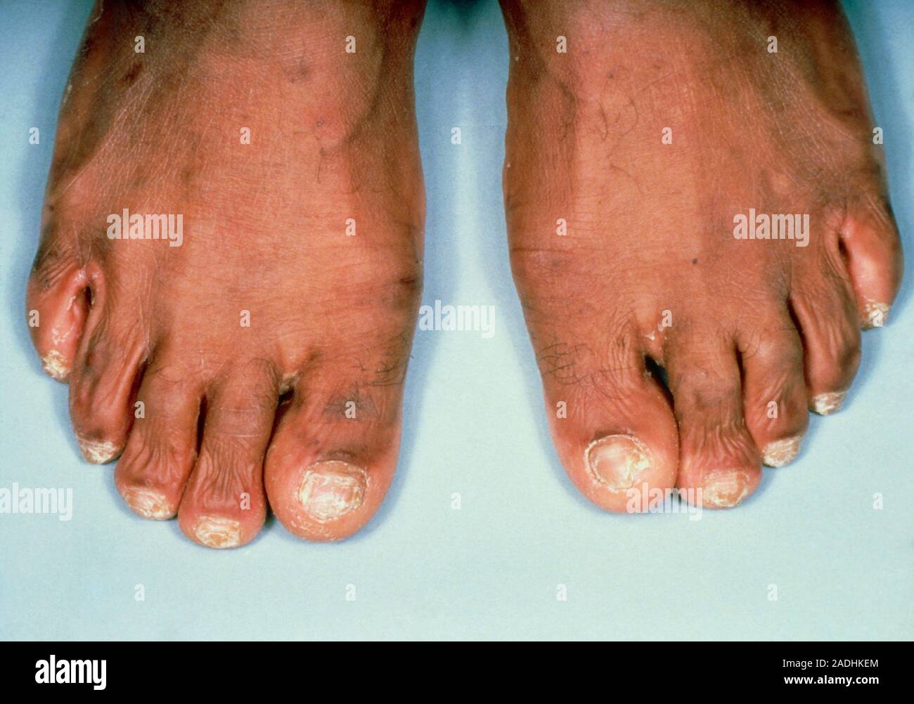 Onychomycosis, a fungal infection of the toes and nails caused by ...