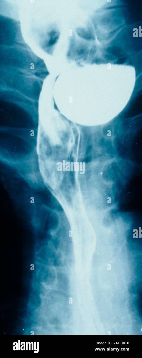 False-colour barium swallow X-ray revealing a pouch (semi-circular ...