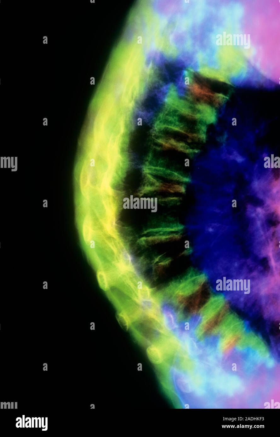 False-colour X-ray of the deformed thoracic spine of a woman suffering ...