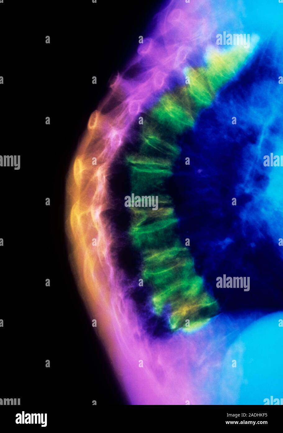 False-colour X-ray of the deformed thoracic spine of a woman suffering ...