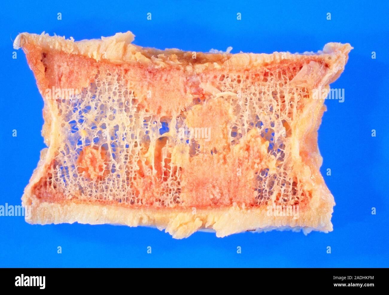 Osteoporosis and metastatic bone cancer. Section through a human ...