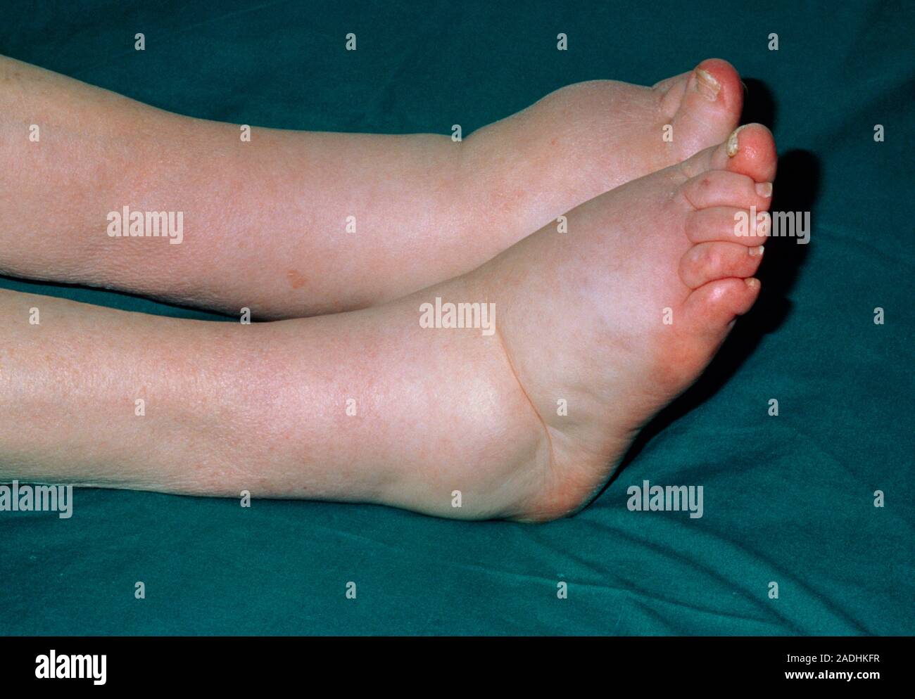 Ankle oedema. Close up of swollen ankles of a patient. Both feet appear ...