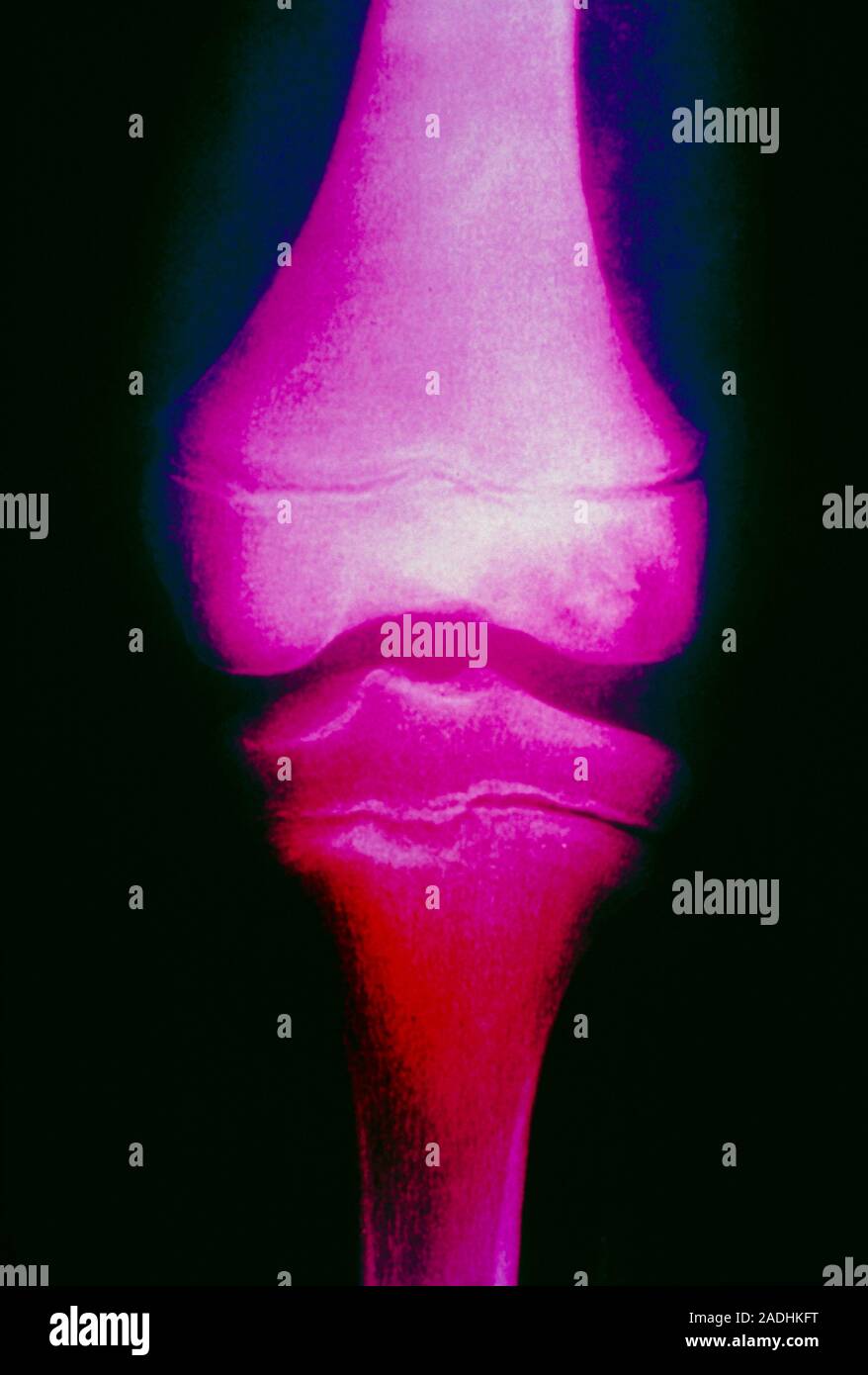 Osteomyelitis. Coloured X-ray of the lower femur (thicker bone top ...
