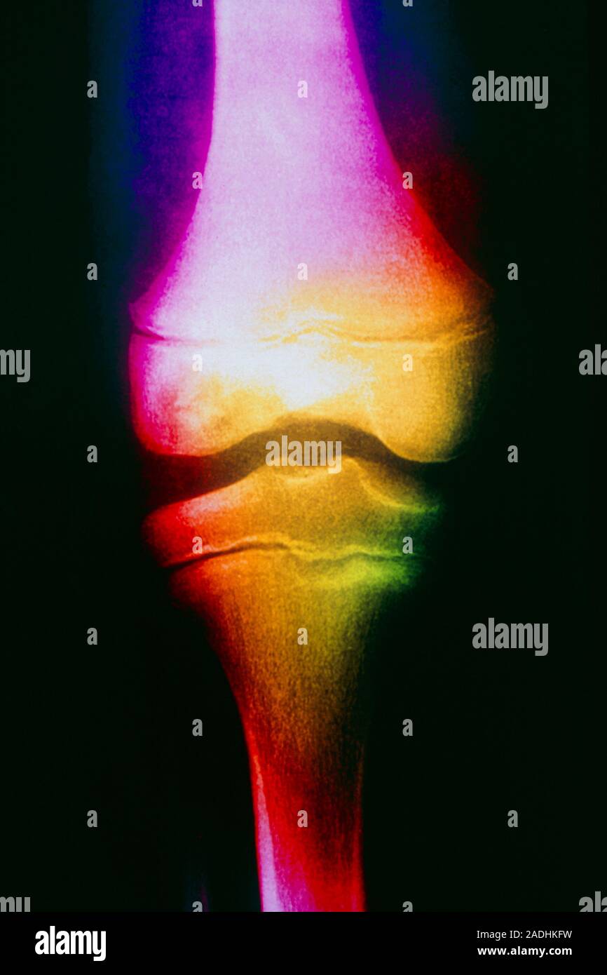 Osteomyelitis. Coloured X-ray of the lower femur (thicker bone top ...