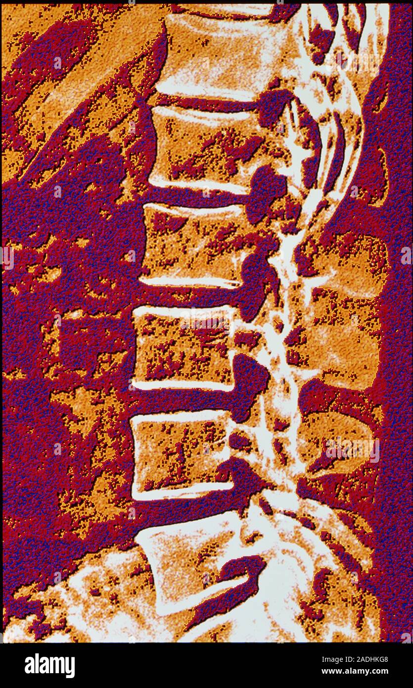 Osteoporosis Coloured Digitised X Ray Of Lumbar Vertebrae In Side View Affected By