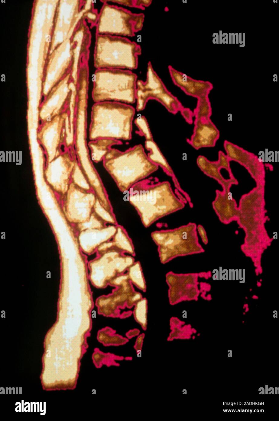 Crumbling spine in osteoporosis. Coloured magnetic resonance imaging ...