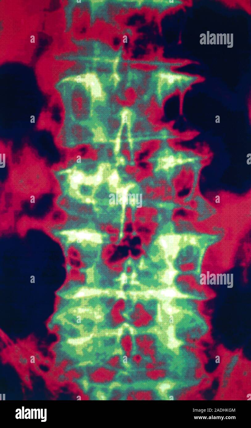 Crumbling spine in osteoporosis. Coloured X-ray of a lower spine ...