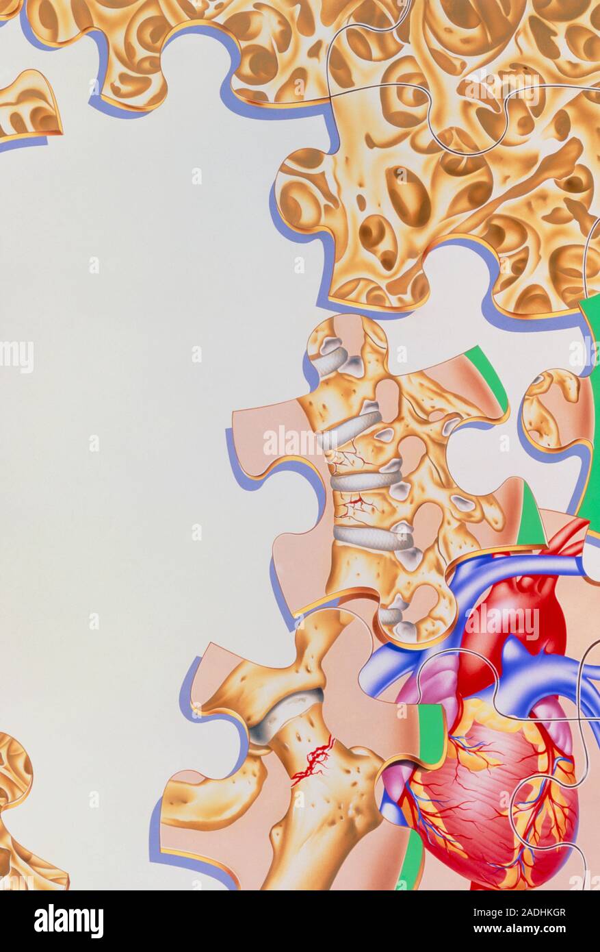 Osteoporosis and heart disease. Artwork showing a the effects of ...