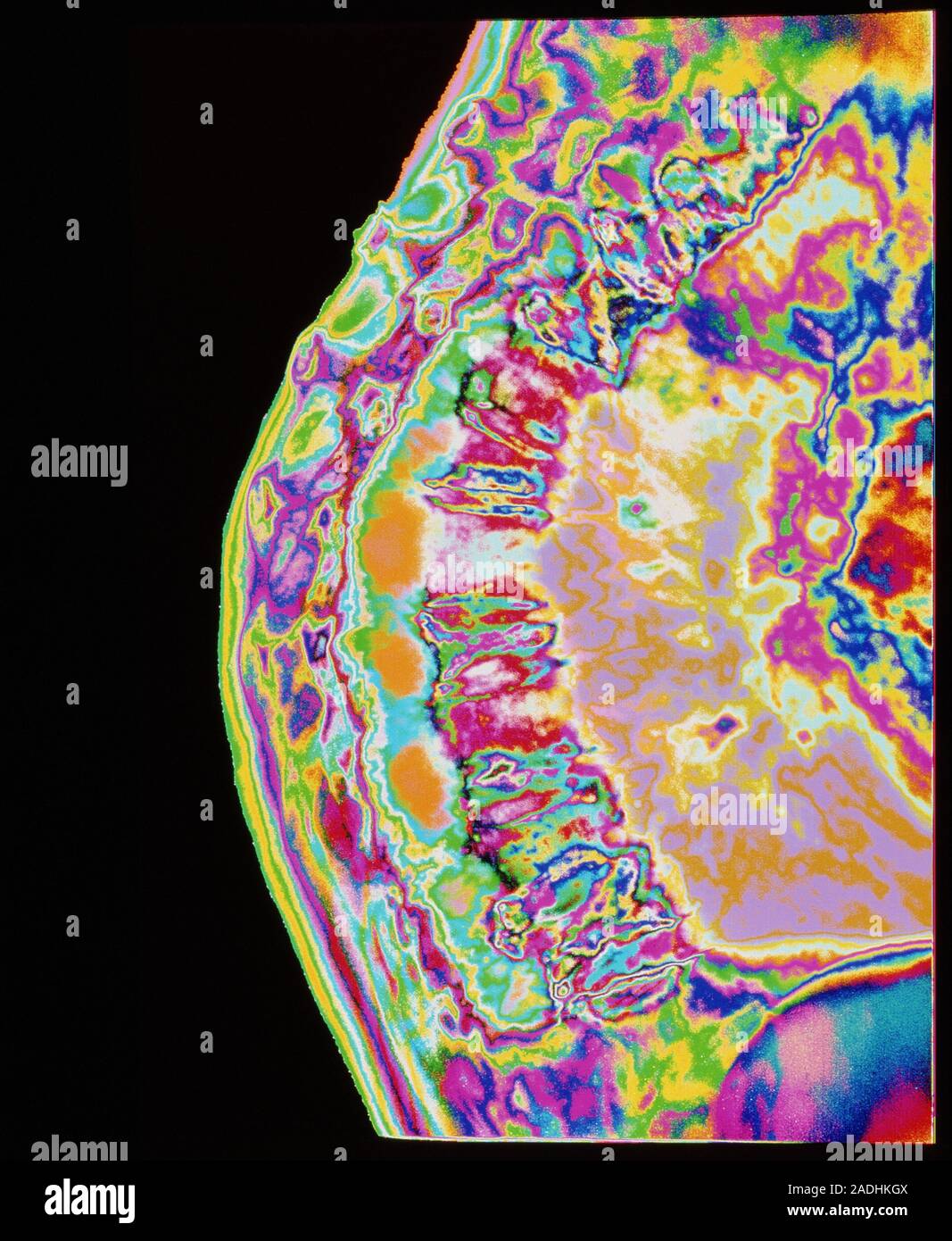 Curved spine in osteoporosis. Computer-enhanced X-ray of the curved and ...