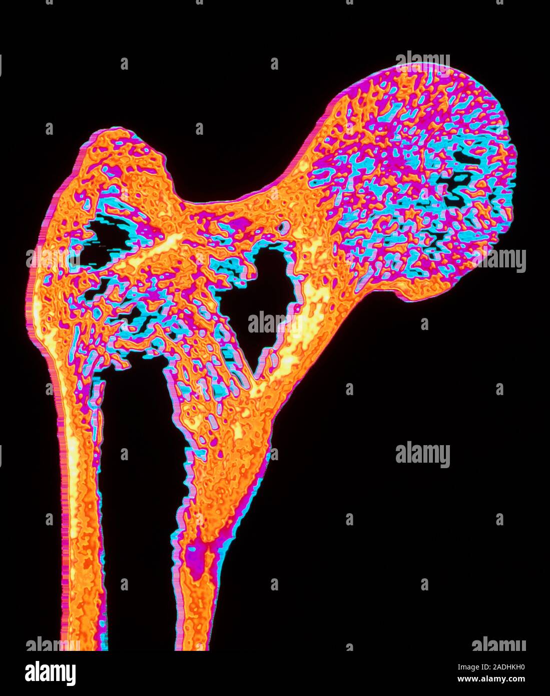 Osteoporosis. Coloured X-ray of the head of a femur thigh bone diseased ...