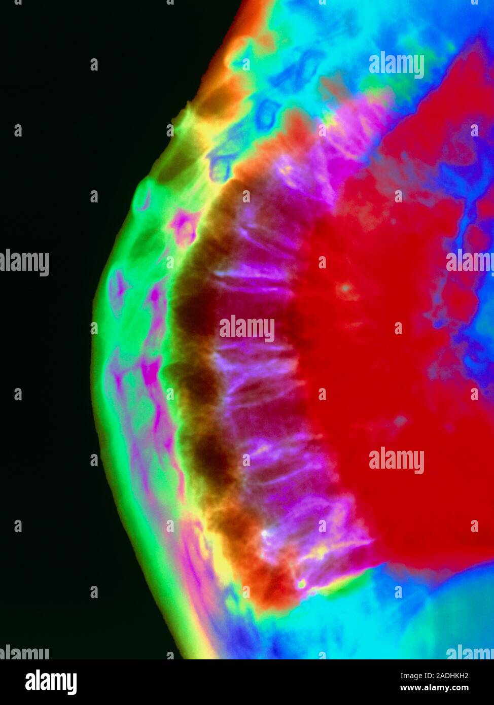 Curved spine in osteoporosis. Computer-enhanced X- ray of the curved ...