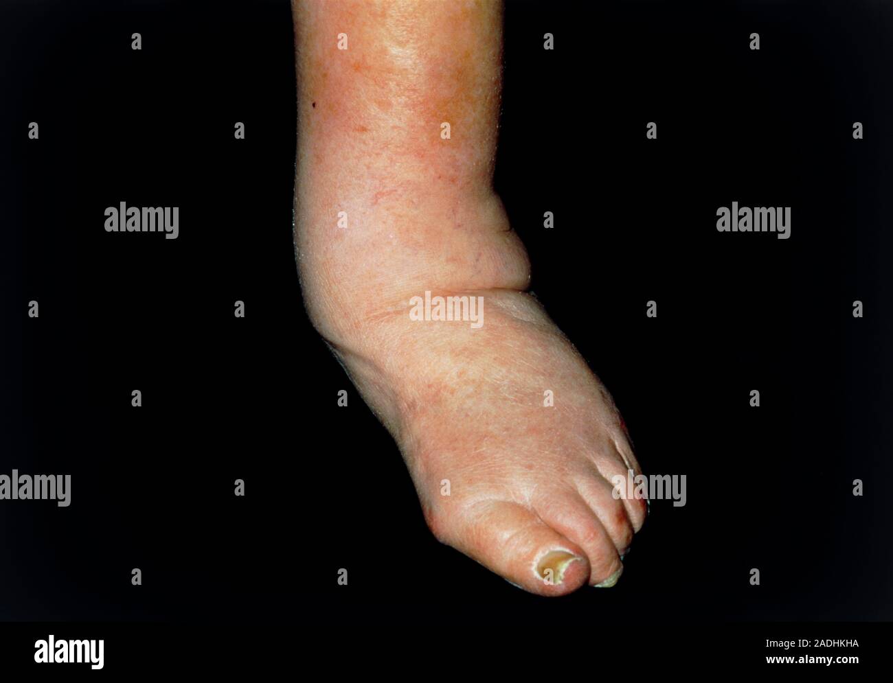Oedema. Deformed and swollen foot and ankle of an 84 year-old woman ...