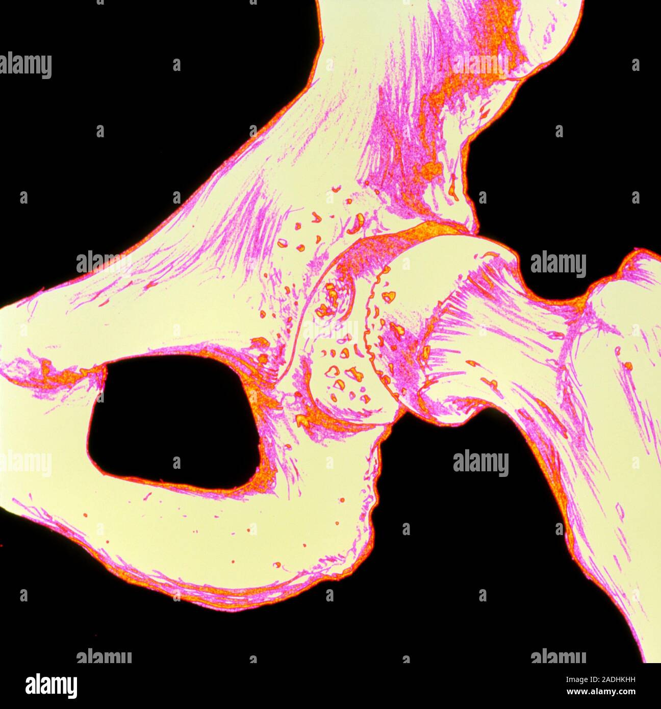 Osteoporosis. Artwork of a female hip joint with osteoporosis. A close ...