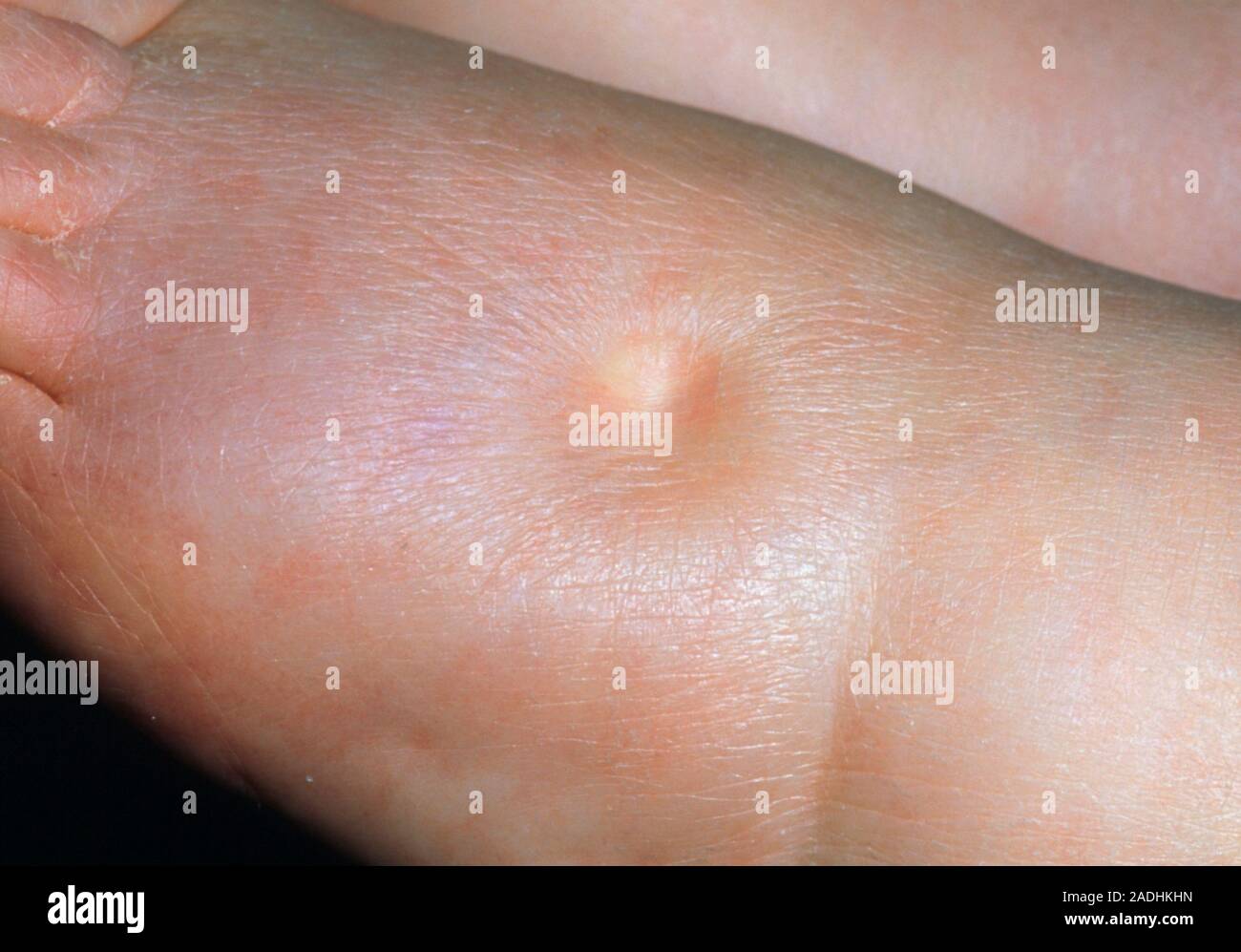 Pitting oedema following heart failure. Close-up of an indented area ...