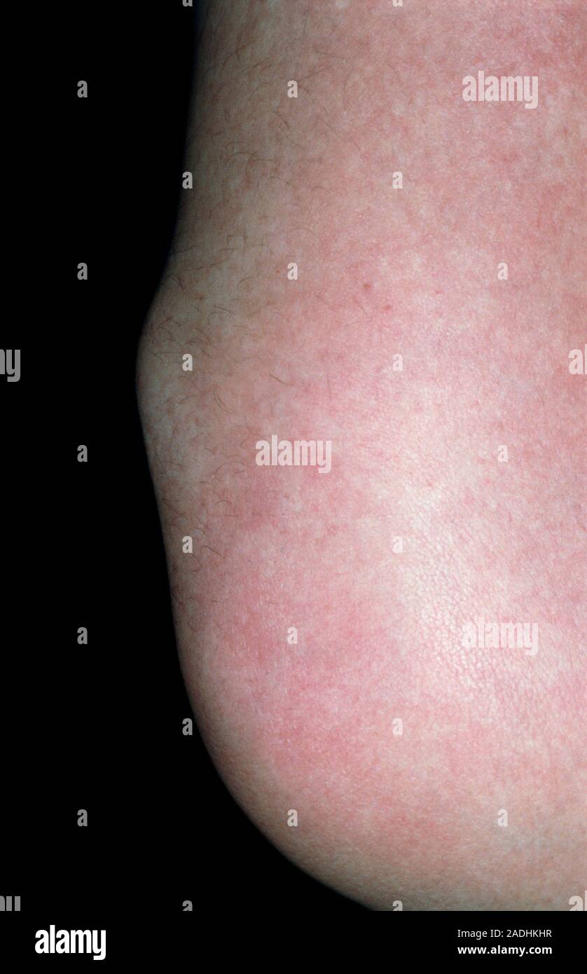 Osgood-Schlatter disease. Side view of the knee of a 17-year-old ...