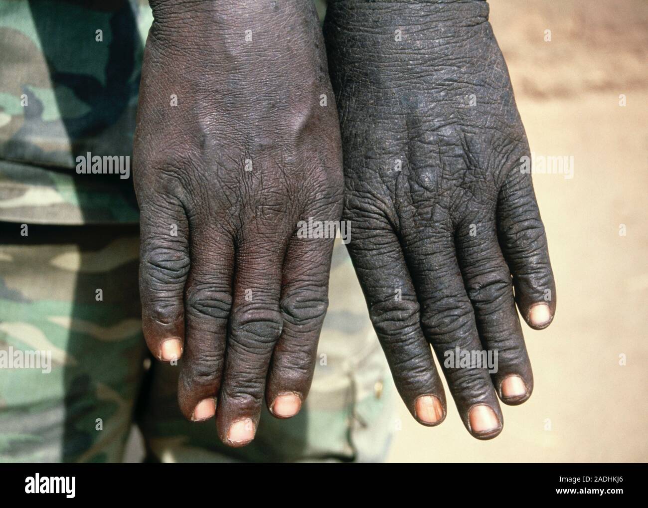 Onchocercal dermatitis. View of the hands of a man suffering from sowda ...