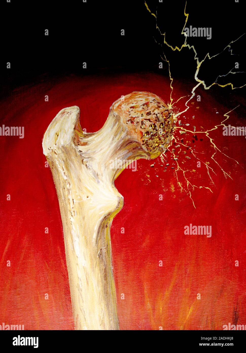 Brittle Bone Disease Vs Osteoporosis at Dorothy Bufkin blog