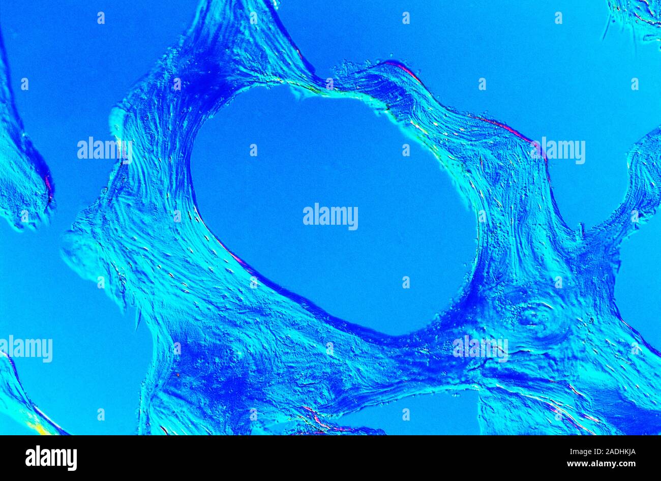 Osteoporosis. Light micrograph of compact bone affected by osteoporosis ...