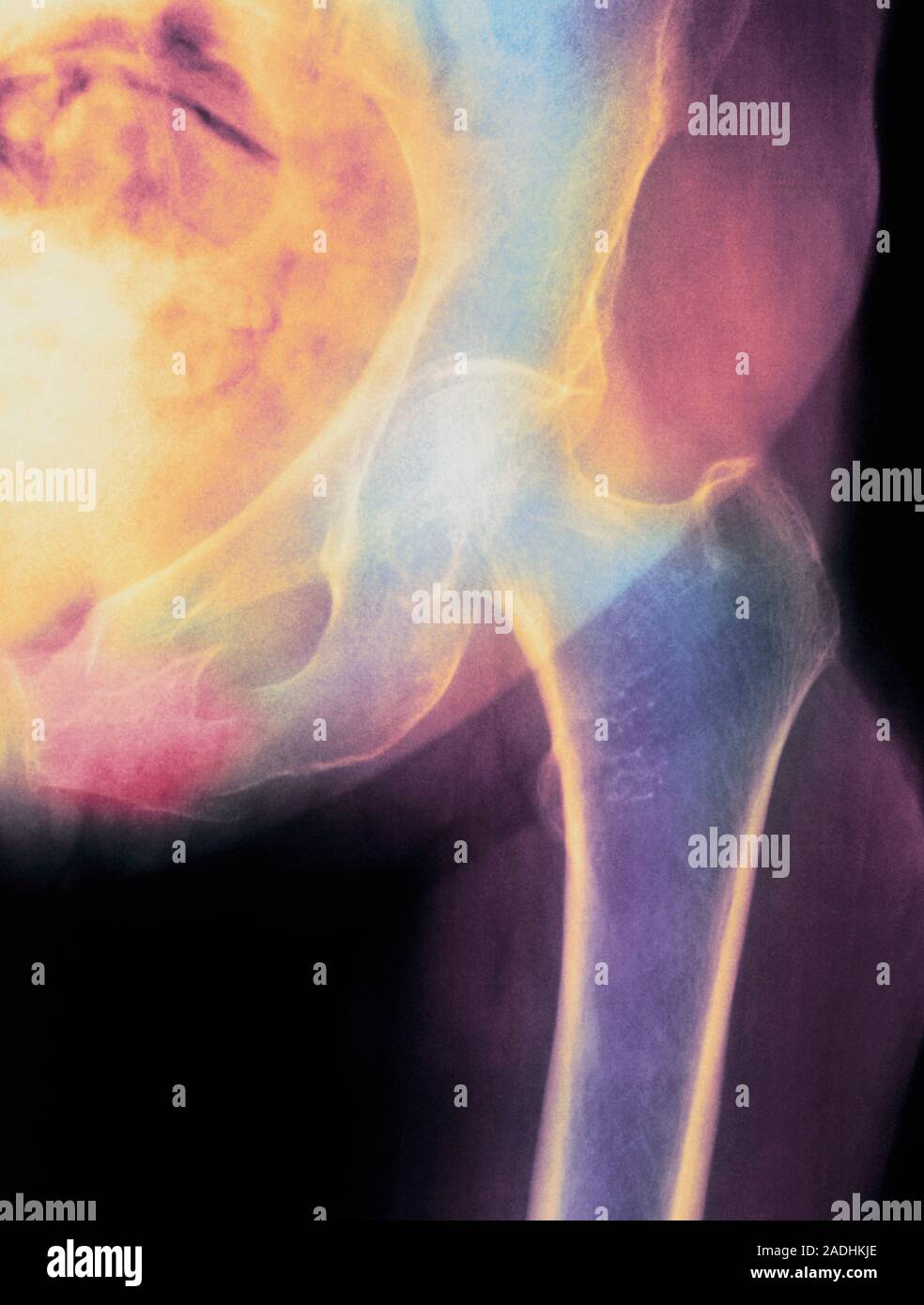 Osteoporosis fracture. Coloured X-ray of the hip of an elderly woman ...